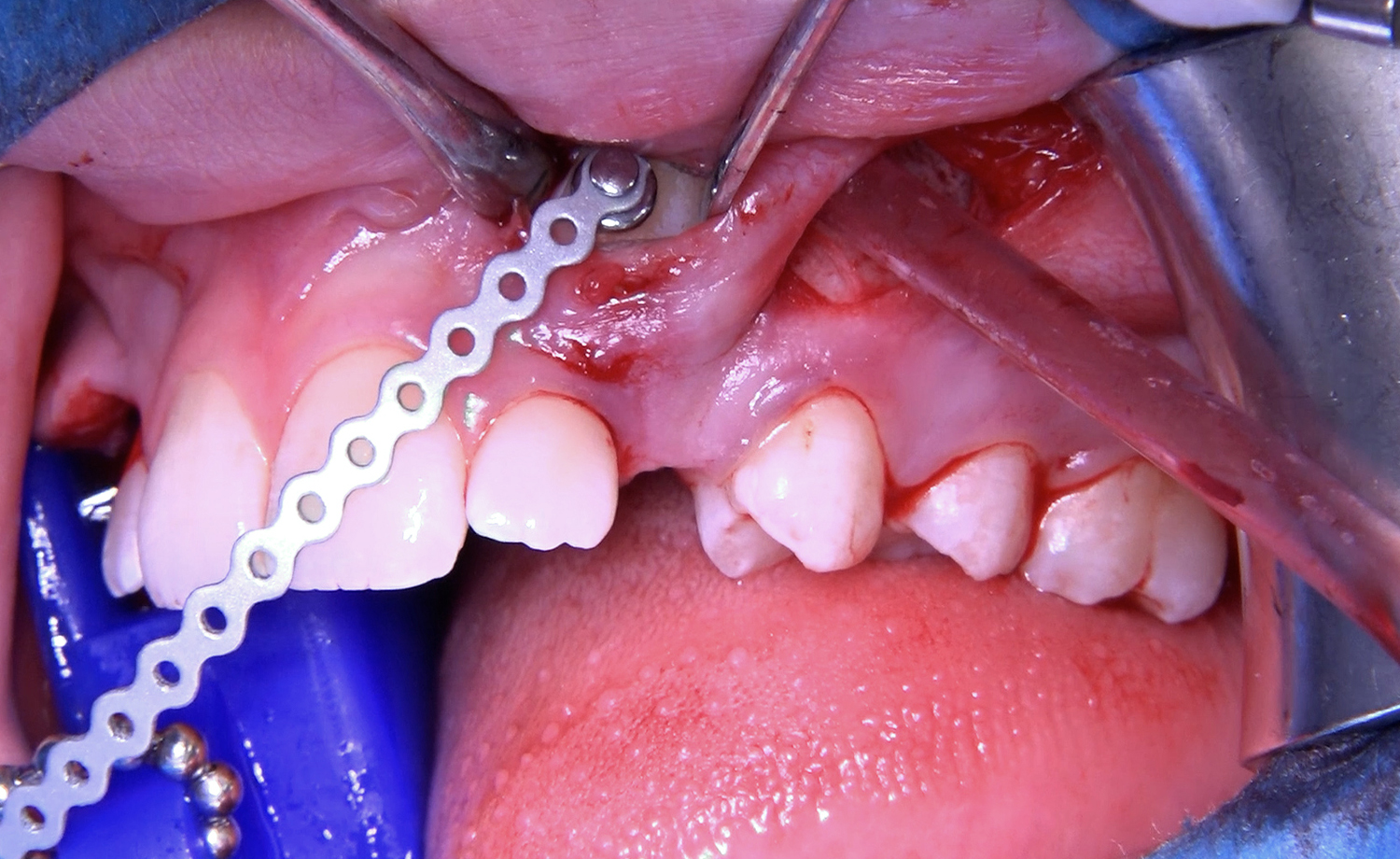 Canine Exposure Using the VISTA Approach - SCHWARTZ-ARADMASTERCLASS